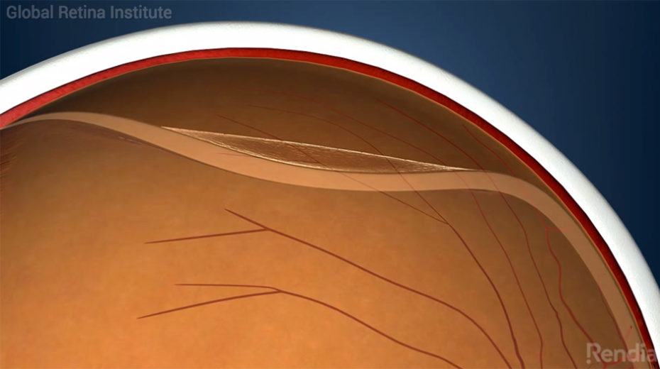 Treating Retinal Detachments - Global Retina Institute
